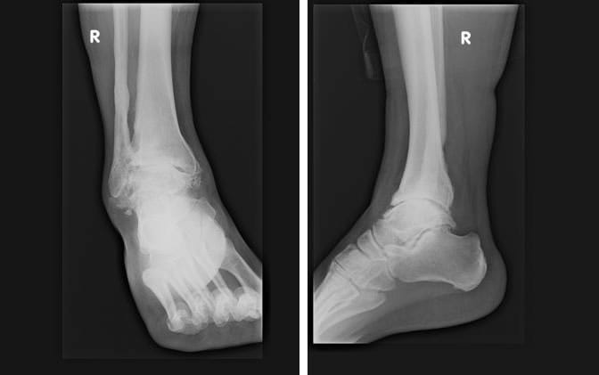 Arthrose des Sprungelenkes | Fuss & Sprunggelenk | Orthozentrum Cham ...