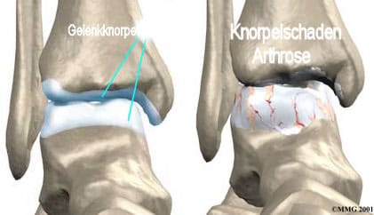 Arthrose des Sprungelenkes | Fuss & Sprunggelenk | Orthozentrum Cham ...
