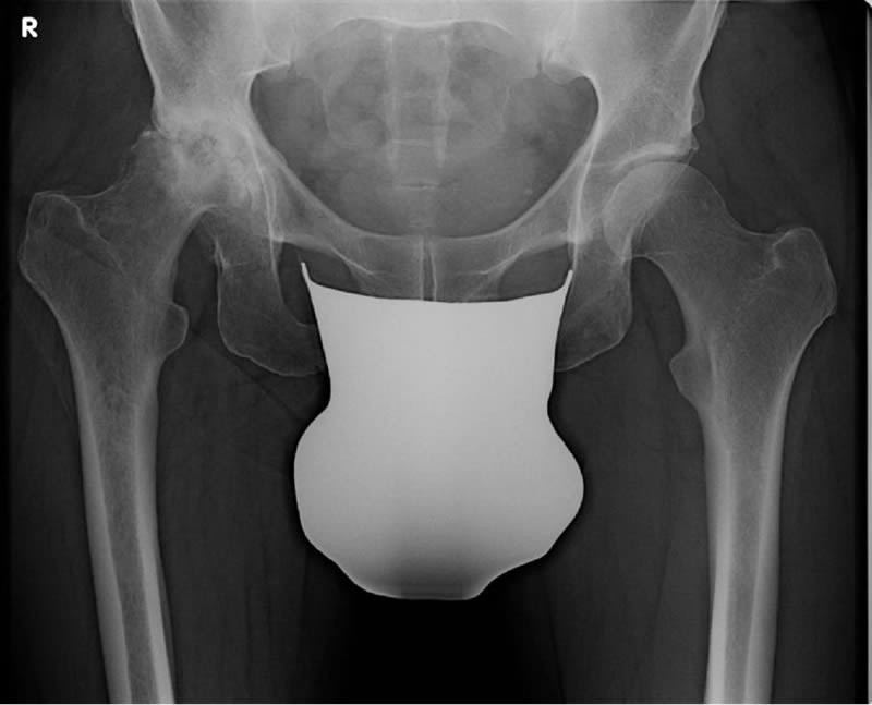 Coxarthrose - Hüftgelenksarthrose | Hüfte & Knie | Orthozentrum Cham ...