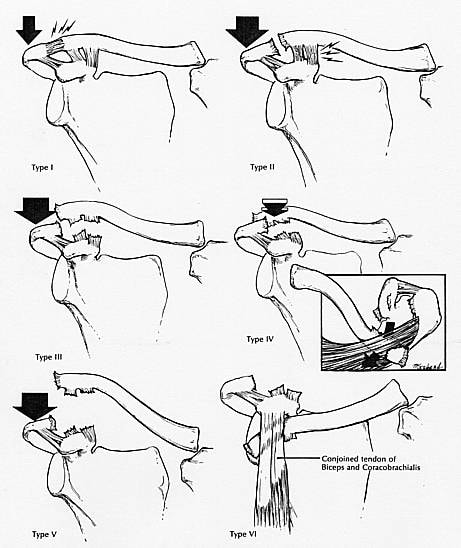 AC-Luxation - Schultereckgelenksprengung | Schulter, Ellbogen & Hand ...