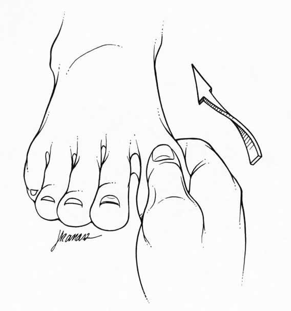 Hallux rigidus - Grosszehengrundgelenksarthrose | Fuss & Sprunggelenk ...